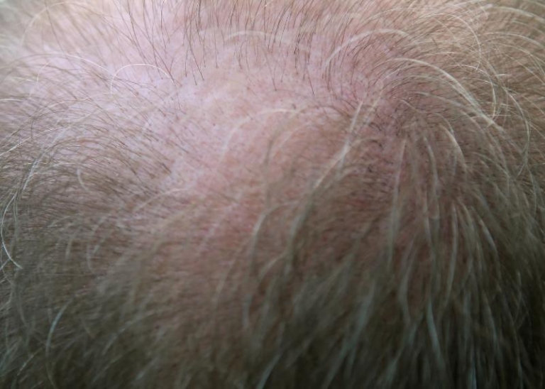 ¿Qué es el efecto shedding o shock loss? Causas y duración